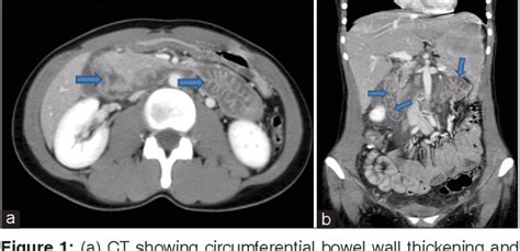 Figure 1 From Mesenteric Vasculitis As A Rare Initial Presentation Of