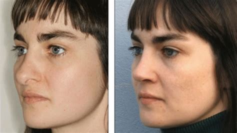 Revision Rhinoplasty To Correct A Hanging Columella See This Young