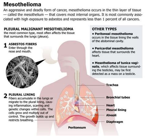 Immunotherapy For Peritoneal Cancer