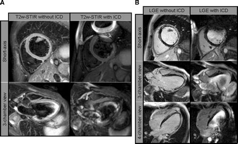 Magnetic Resonance Of The Heart In A Muscular Dystrophy Patient With An Mr Conditional Icd