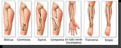 Accidentes de tráfico y consecuencias FRACTURA