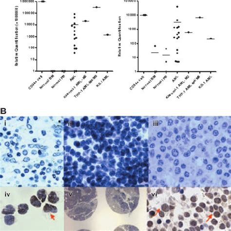 Sall4 Expression In Human Primary Aml And Myeloid Leukemia Cell Lines