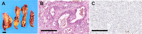 double somatic mutations in ctnnb1 and gna11 in an aldosterone