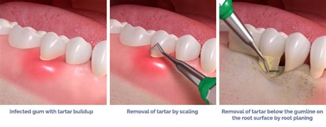 Scaling And Root Planing Deep Cleaning