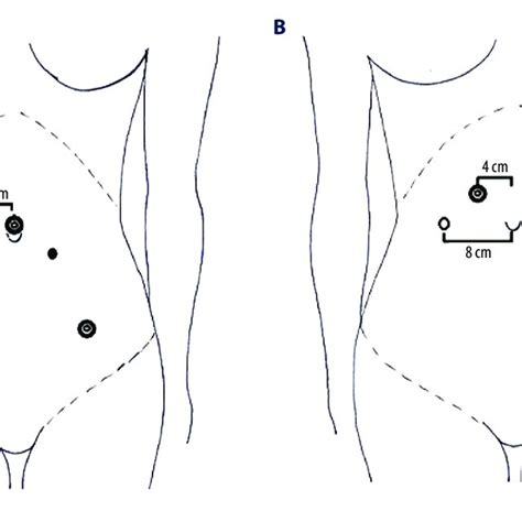 Schematic Diagram Showing The Port Placement For Robotic Assisted And Download Scientific