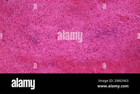 Lymphatic Tissue Stock Videos And Footage Hd And 4k Video Clips Alamy