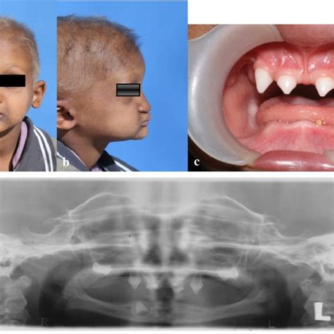 Pdf Dental Management Of Ectodermal Dysplasia Two Clinical Case Reports