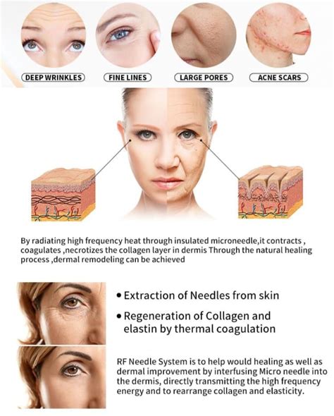 New Updated Style Gold Rf Fractional Micro Needling Machine Skinsoft