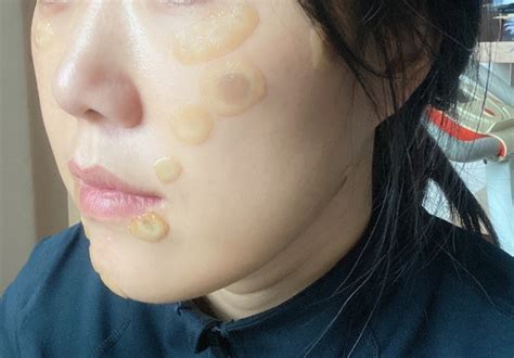 전주 흑자제거 리팟레이저 11일째 재생테이프 붙이고 있는 중 제거확인 후 재포스팅 예정 네이버 블로그