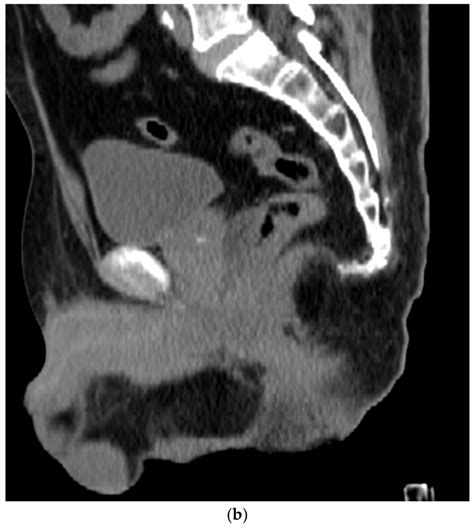 Application Of Hydrogel Spacer Spaceoar Vue For Prostate Radiotherapy Pmc