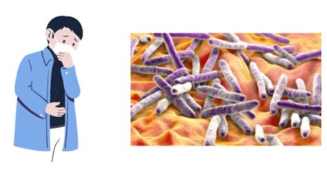 What Is The Step TB Test Tuberculosis Best TB Care
