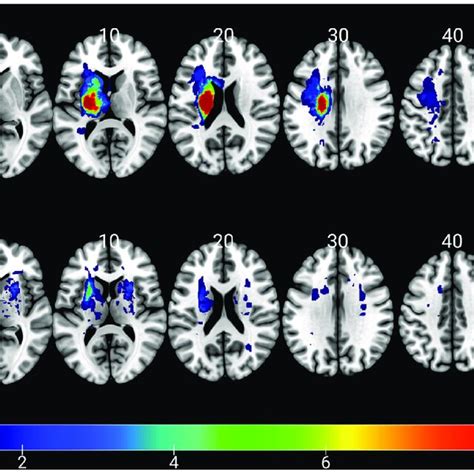 Lesion Overlap Maps Of A Acute Stroke Lesions And B Prior Stroke Download Scientific Diagram