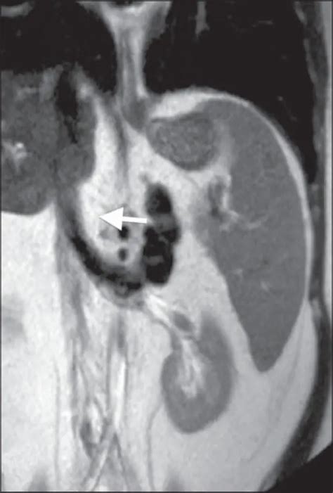 Portosystemic Collaterals Radiology