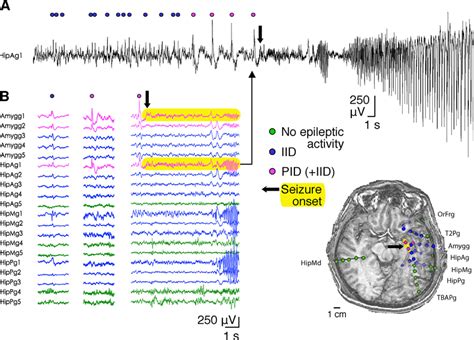 In Vivo Stereoelectroencephalographic Seeg Recording Of Pre Ictal