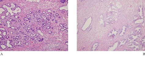 Prostate Adenocarcinoma Histology