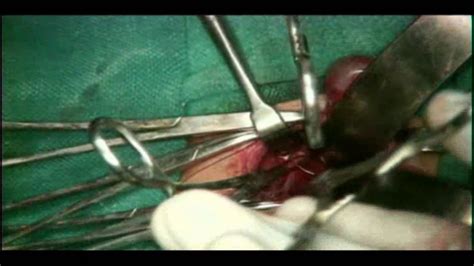 Nehrectomy For Mckd By Dr Dd Sharma Youtube