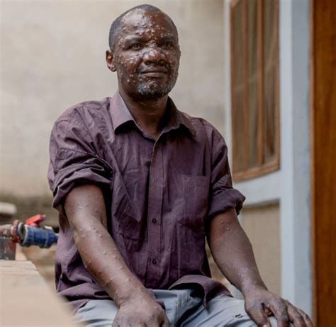 Ncdc Reports Higher Mpox Infection Among Males In Nigeria