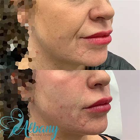 Edmonton Dermal Fillers And Anit Aging Clinic Albany Laser