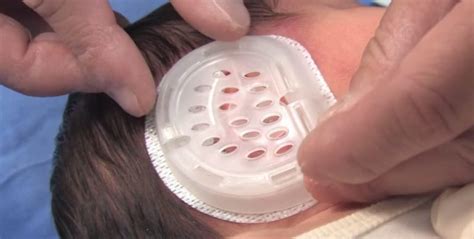 Earwell™ Infant Ear Correction System Now Offered At Texas Ent