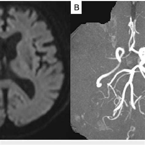 Mri On Admission Mri Showed A Slight Diffusion Weighted Imaging Dwi
