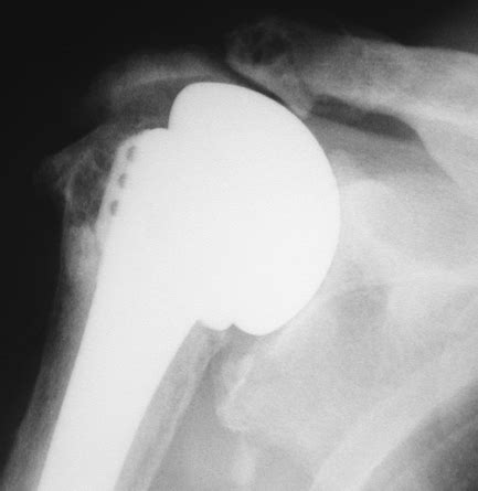HIP Dislocations Femoral Head Fractures And Acetabular Fractures TeachMe Orthopedics
