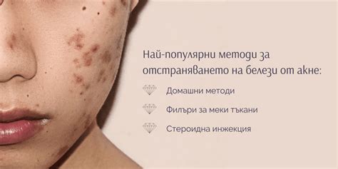 Белези от акне Как да се отървем от тях завинаги