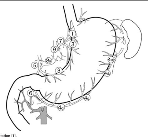Figure 2 From V Shaped Lymph Node Dissection In Laparoscopic Distal