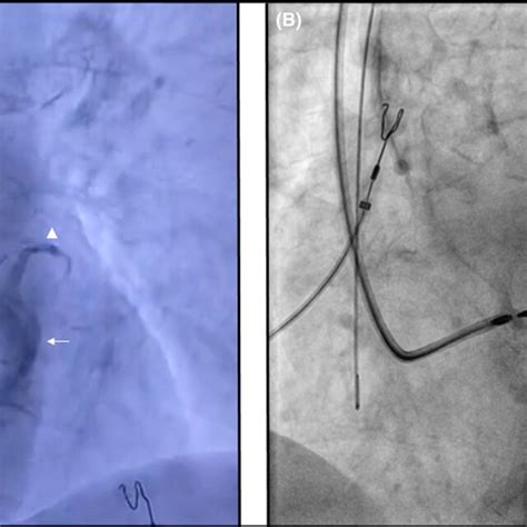 A Anteroposterior Projection Showing Contrast Injection Through The