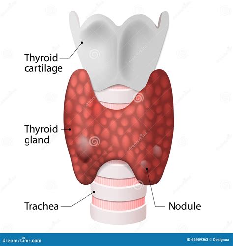 Thyroid Nodules Are Solid Or Fluid Filled Lumps On The Surface Of The