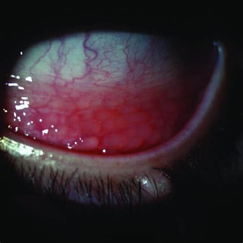 Follicular Conjunctivitis And Mc Lesion On The Eyelid Margin Download Scientific Diagram