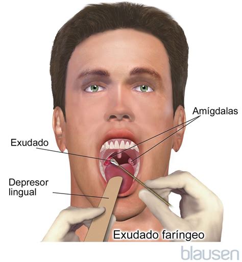 Infección De Garganta Infección De Garganta Manual Msd Versión Para