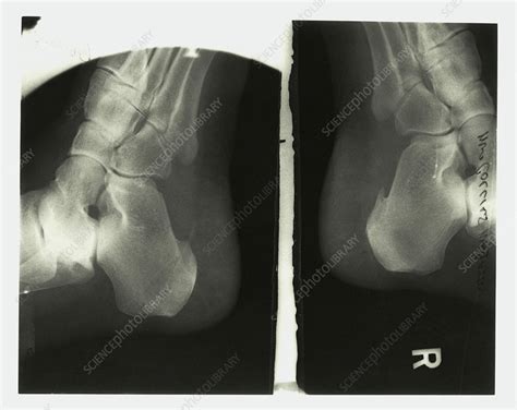 Heel Of Foot X Ray Stock Image C053 4885 Science Photo Library