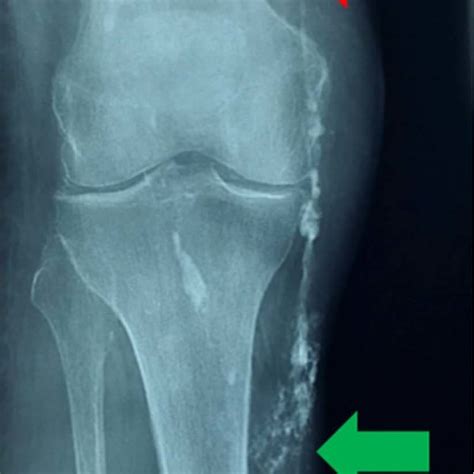 Types Of Skin Calcifications And Related Diseases With Some Of Their