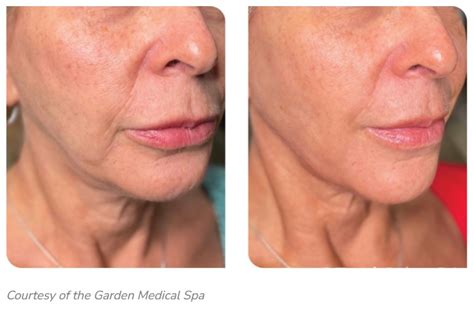 Envy Skin Clinics Ultimate Non Surgical Facelift Trilift®