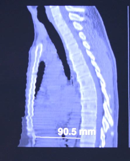 Thorax Фото До и После
