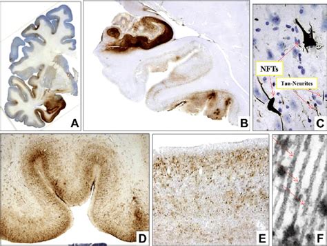Typical Cerebral Regions And Cortical Localization Of Tau Nfts In Rtbi