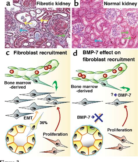 Figure 3 From Epithelial Mesenchymal Transition And Its Implications