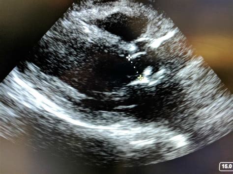 Cardiac Output With Lvot Measurements Using Echocardiography Rk Md