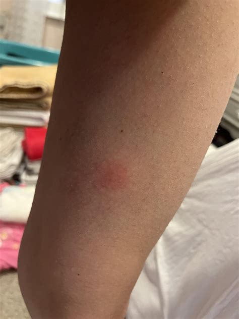 Are These Hives Rurticaria
