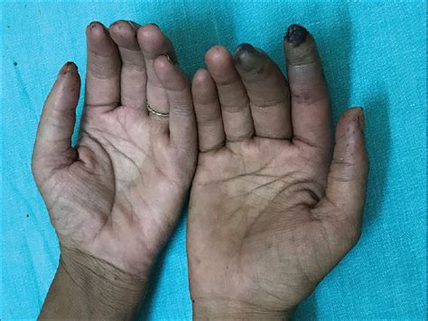 Anti Ro 52 Positive Systemic Sclerosis Sine Scleroderma With Multisystem Involvement And