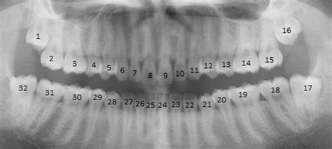 Numbering And Classification Of Panoramic Dental Images 58 Off