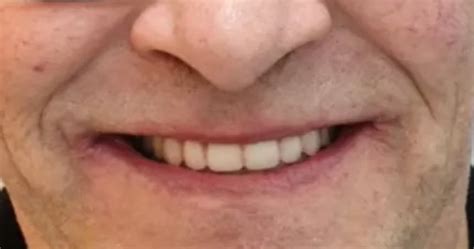 Antes Y Después Implantes Dentales Ciudad De México Cdmx