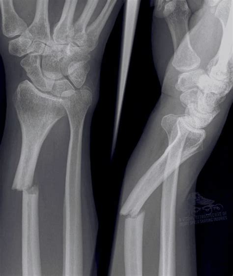 broken wrist x ray