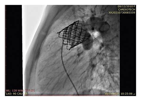 Case 1 A MSCT Showing The Tubular Shaped MPA PA Annular Size And