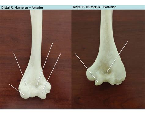 Distal R Humerus Quiz