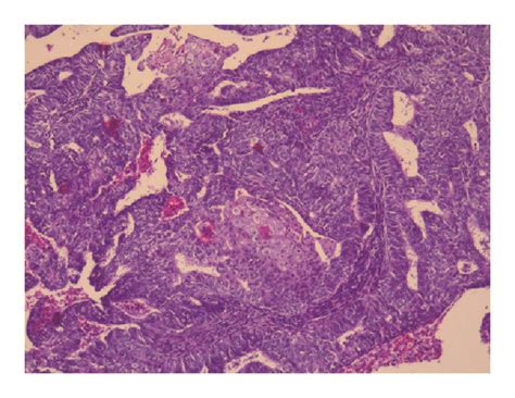 Microscopic Appearance Of Endometrioid Carcinoma With Foci Of Squamous Download Scientific