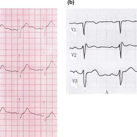 The Coved Type 1 Brugada Ecg Pattern In A 65 Patients Spontaneously Download Scientific