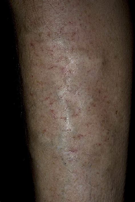 Stasis Dermatitis On Legs Pictures 174 Photos And Images