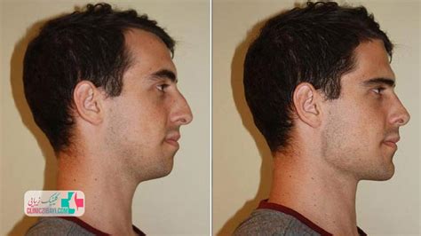 زاویه سازی فک و صورت با تزریق ژل چگونه است؛ ماندگاری و هزینه زاویه سازی