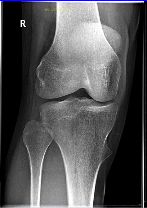Excision Of Right Proximal Tibial Exostosis Cecile Variety And Potential Recurrent Branch